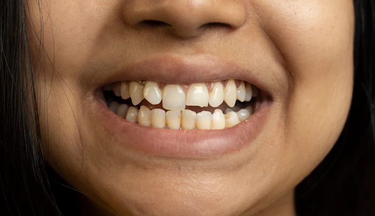 TMJ Aiken, SC - TMJ Treatment - Center for Dentistry