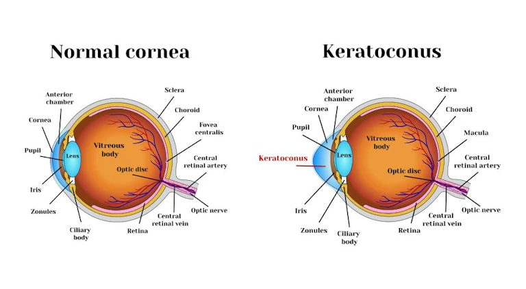 Keratoconus Erie, PA - Contemporary Ophthalmology of Erie