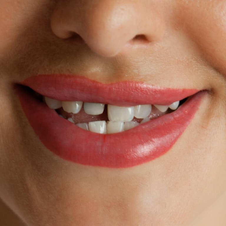 Dental Crowns Kailua-Kona, HI - Tooth Crown - Sweet Tooth Dental