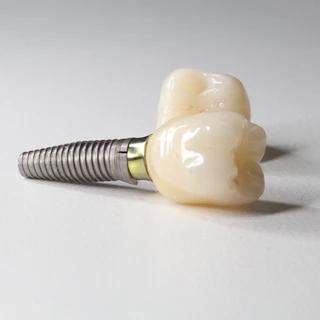 Dental Implants Los Algodones, Baja California - Implant Dentistry ...