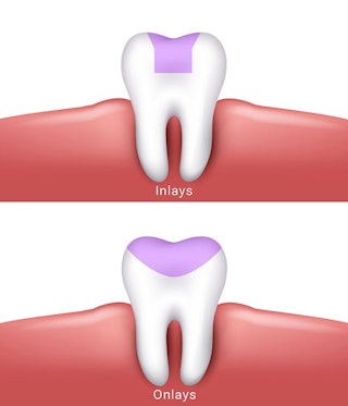 Inlays and Onlays - Loveland, CO - West Lake Dental