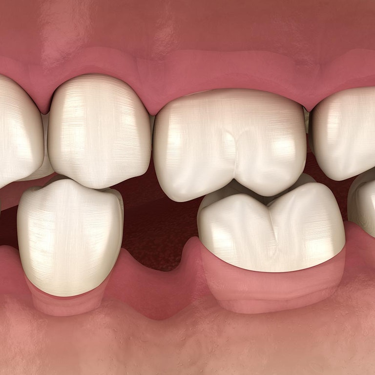 Dental Bridges Carthage, MS - Jackson, MS - Philadelphia, MS - Tooth ...